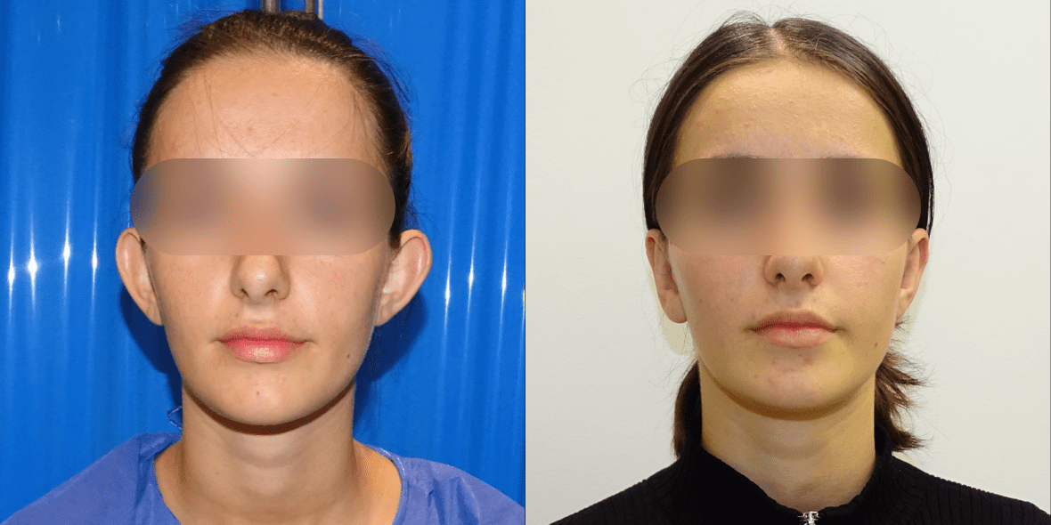 Otoplasty Surgery in London | Ear Enhancement