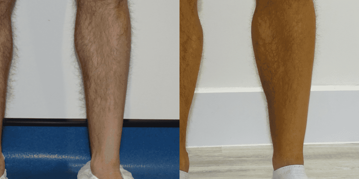 Calf Augmentation in London (Implants or Fat Transfer)