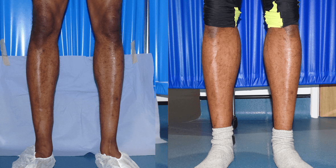 How Much Do Calf Implants Cost in the UK?