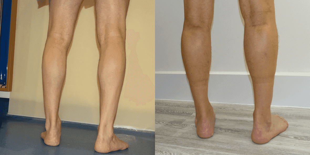 Calf Augmentation in London (Implants or Fat Transfer)