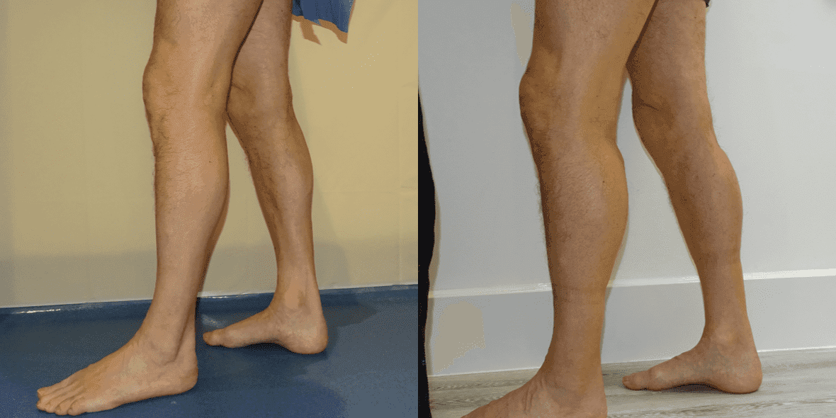 Calf Augmentation in London (Implants or Fat Transfer)