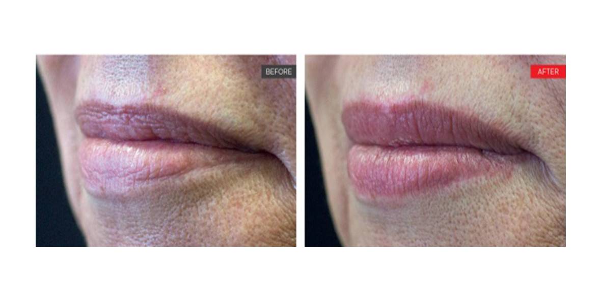 Lip Laser Treatment London (LipLase) | A New You