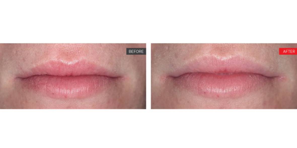 Lip Laser Treatment London (LipLase) | A New You
