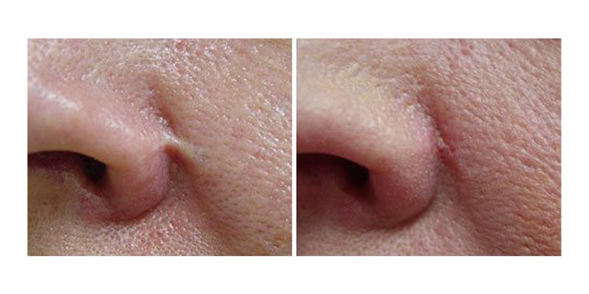 Laser Scar Removal London | Everything to Know [Video]