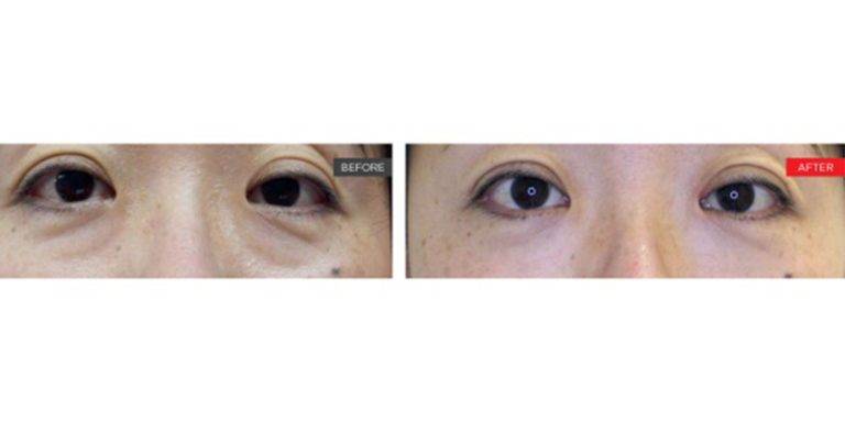 Laser Eyelid Tightening | Achieve Refreshed Eye Contours