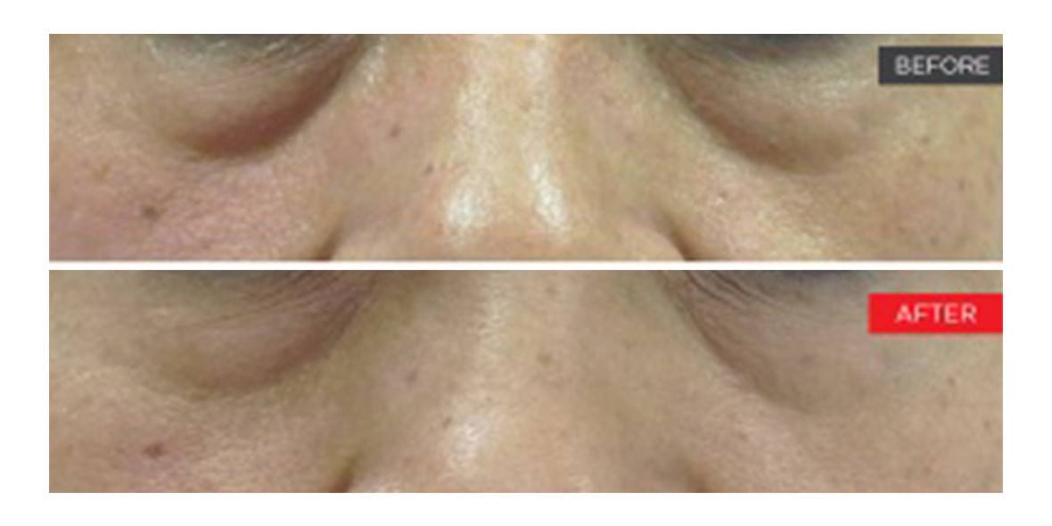 SmoothEye Laser Treatment London | Rejuvenate Your Image