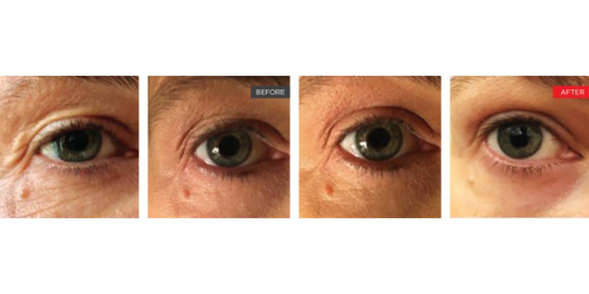 Laser Eyelid Tightening | Achieve Refreshed Eye Contours