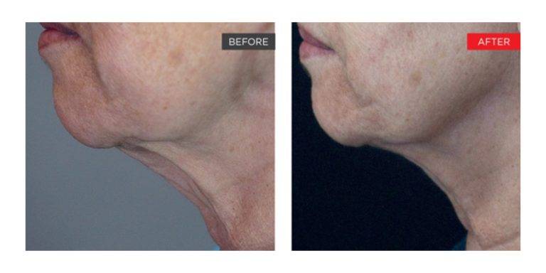 A Complete Guide to Non-Surgical Face Lift Procedures