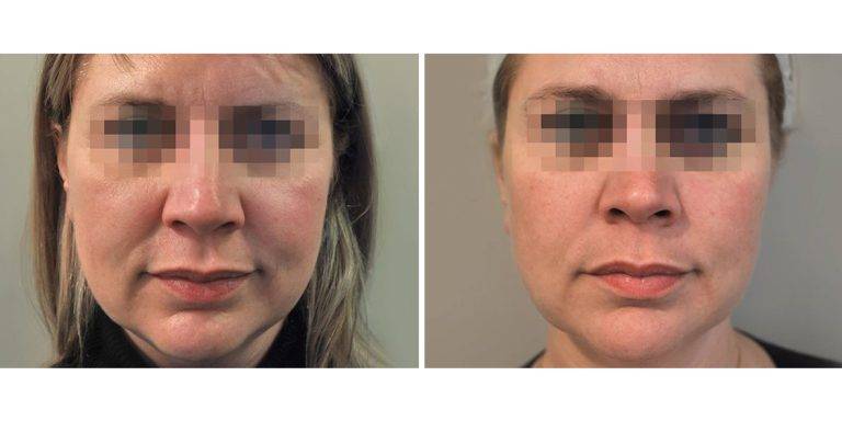 Profhilo Benefits: What You Need to Know