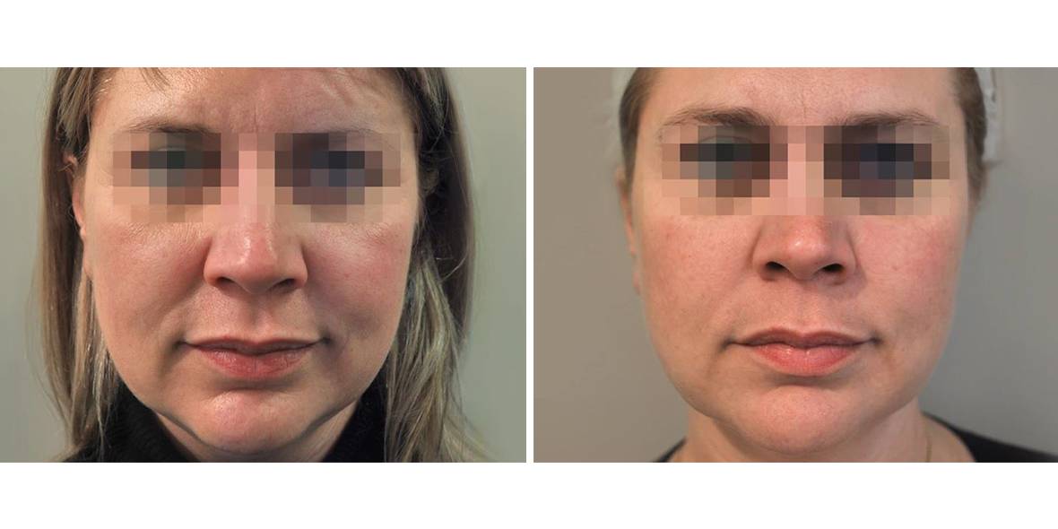 Profhilo Benefits: What You Need to Know