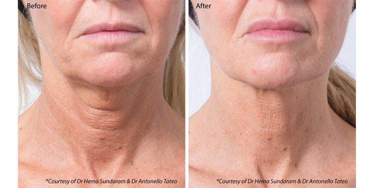 Profhilo Benefits: What You Need to Know