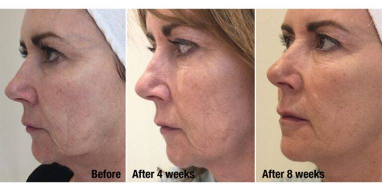 Effects of Profhilo for the Eyes: Before & After