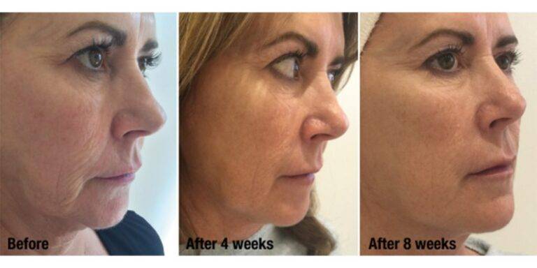 Effects of Profhilo for the Eyes: Before & After